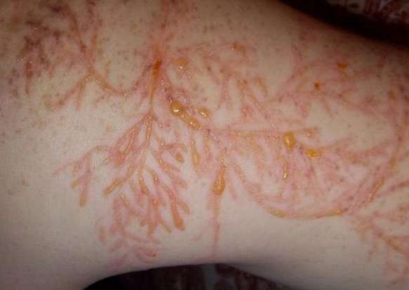 Lesiones por fulguración: aspectos clínicos y médicos legales