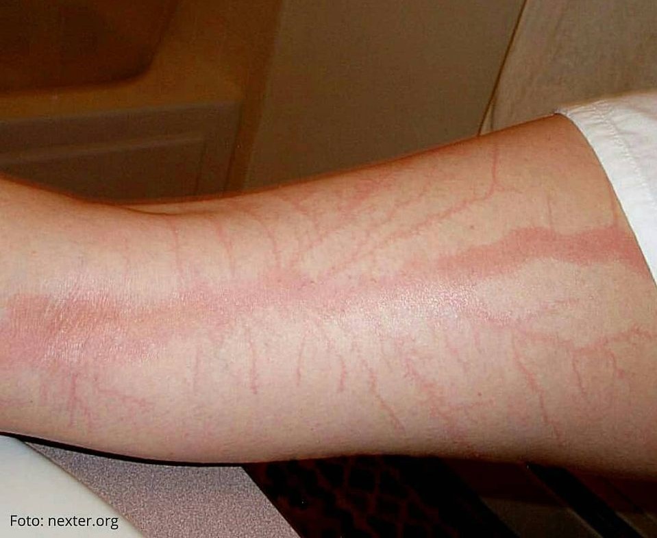 Lesiones por fulguración: aspectos clínicos y médicos legales